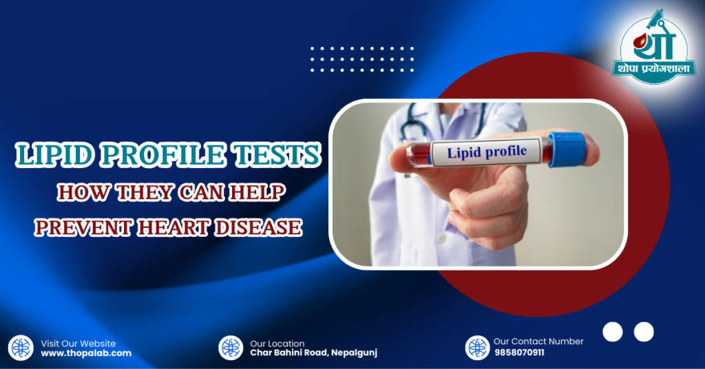 Lipid Profile Tests: How They Can Help Prevent Heart Disease